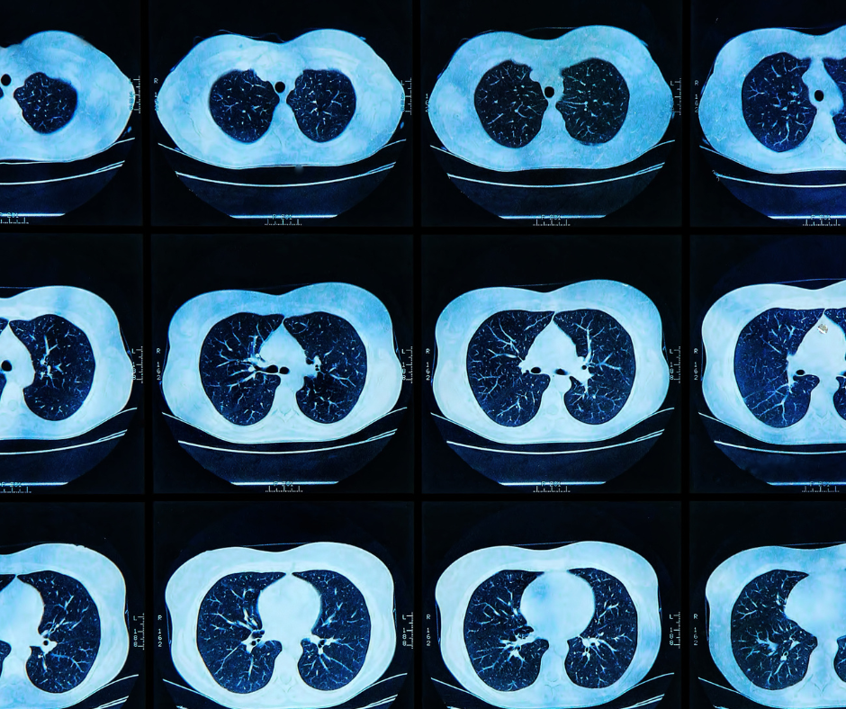 Multi-organ MRI findings after COVID-19 admission - Breathing Matters ...